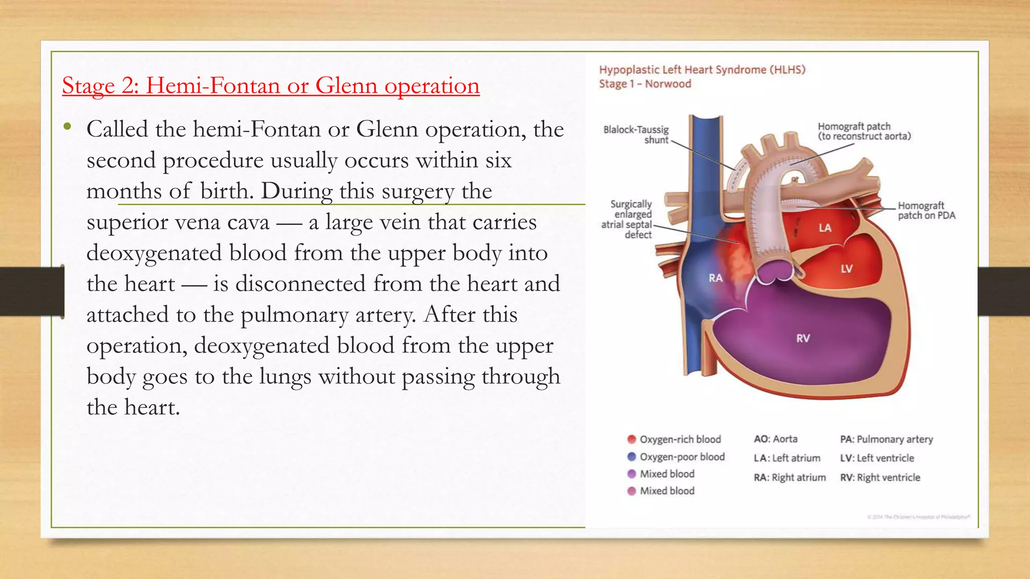 Norwood Procedure.pptx