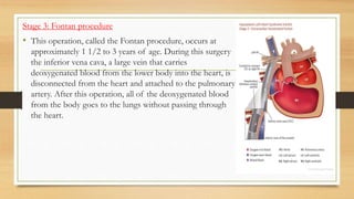 Norwood Procedure.pptx