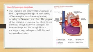 Norwood Procedure.pptx