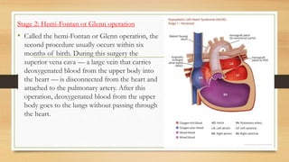 Norwood Procedure.pptx