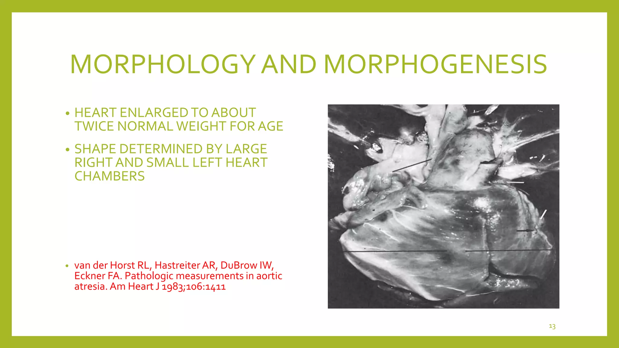 HYPOPLASTIC LEFT HEART SYNDROME & NORWOOD PROCEDURE- A REVIEW | PPTX