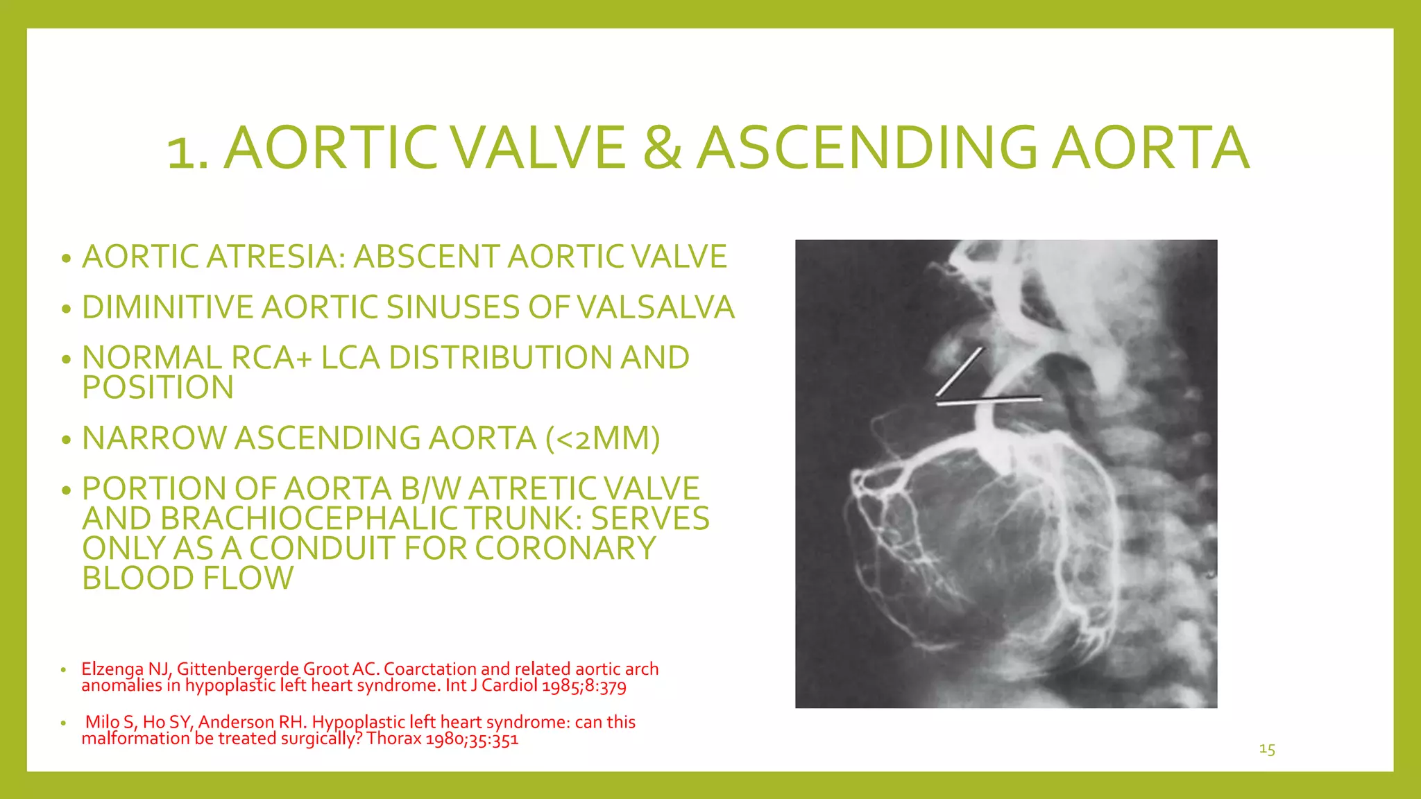 HYPOPLASTIC LEFT HEART SYNDROME & NORWOOD PROCEDURE- A REVIEW | PPTX