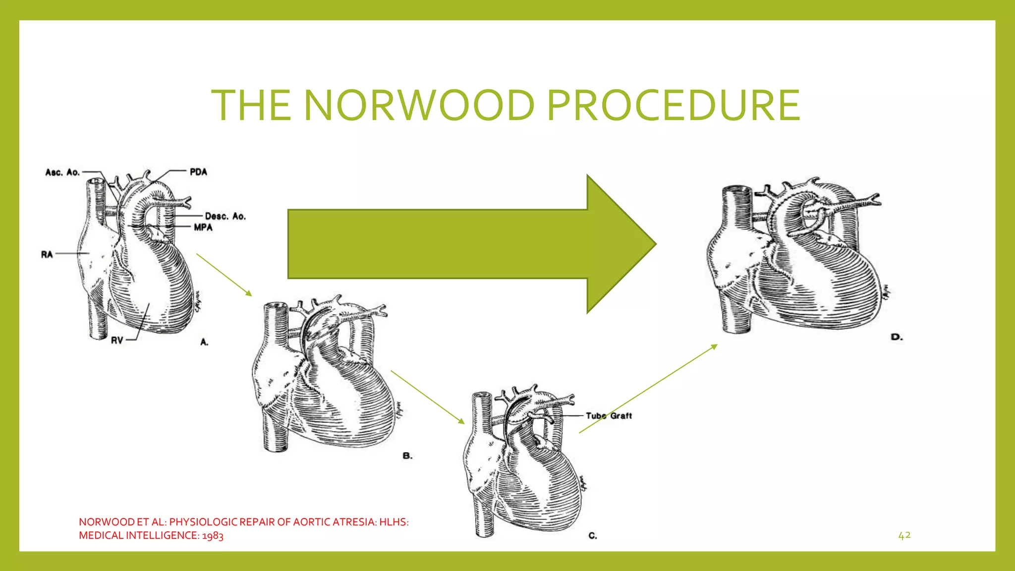 HYPOPLASTIC LEFT HEART SYNDROME & NORWOOD PROCEDURE- A REVIEW | PPT