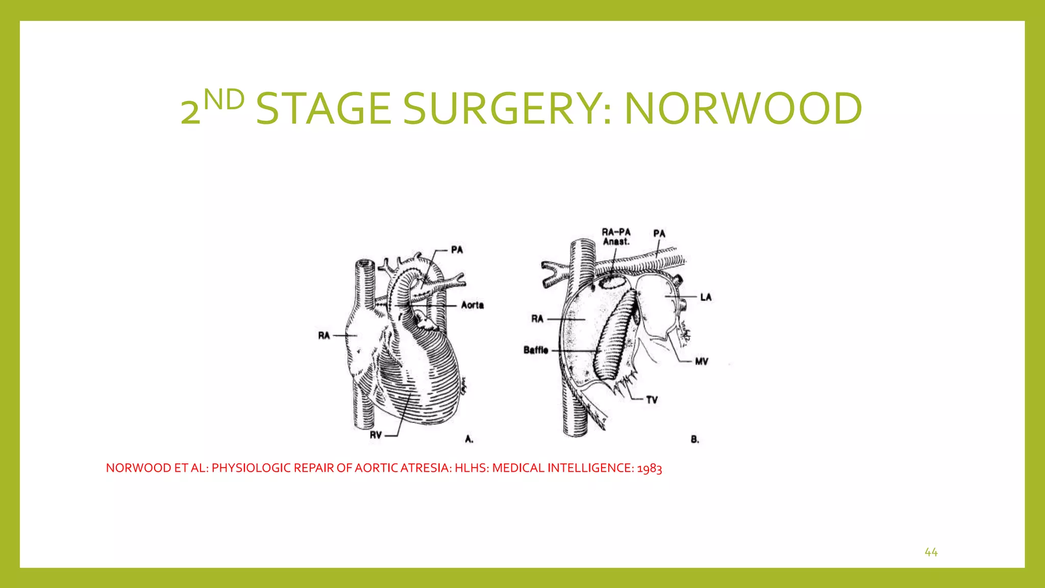 HYPOPLASTIC LEFT HEART SYNDROME & NORWOOD PROCEDURE- A REVIEW | PPTX