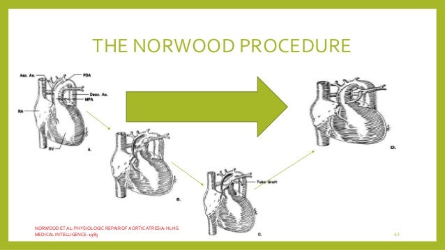 HYPOPLASTIC LEFT HEART SYNDROME & NORWOOD PROCEDURE- A REVIEW