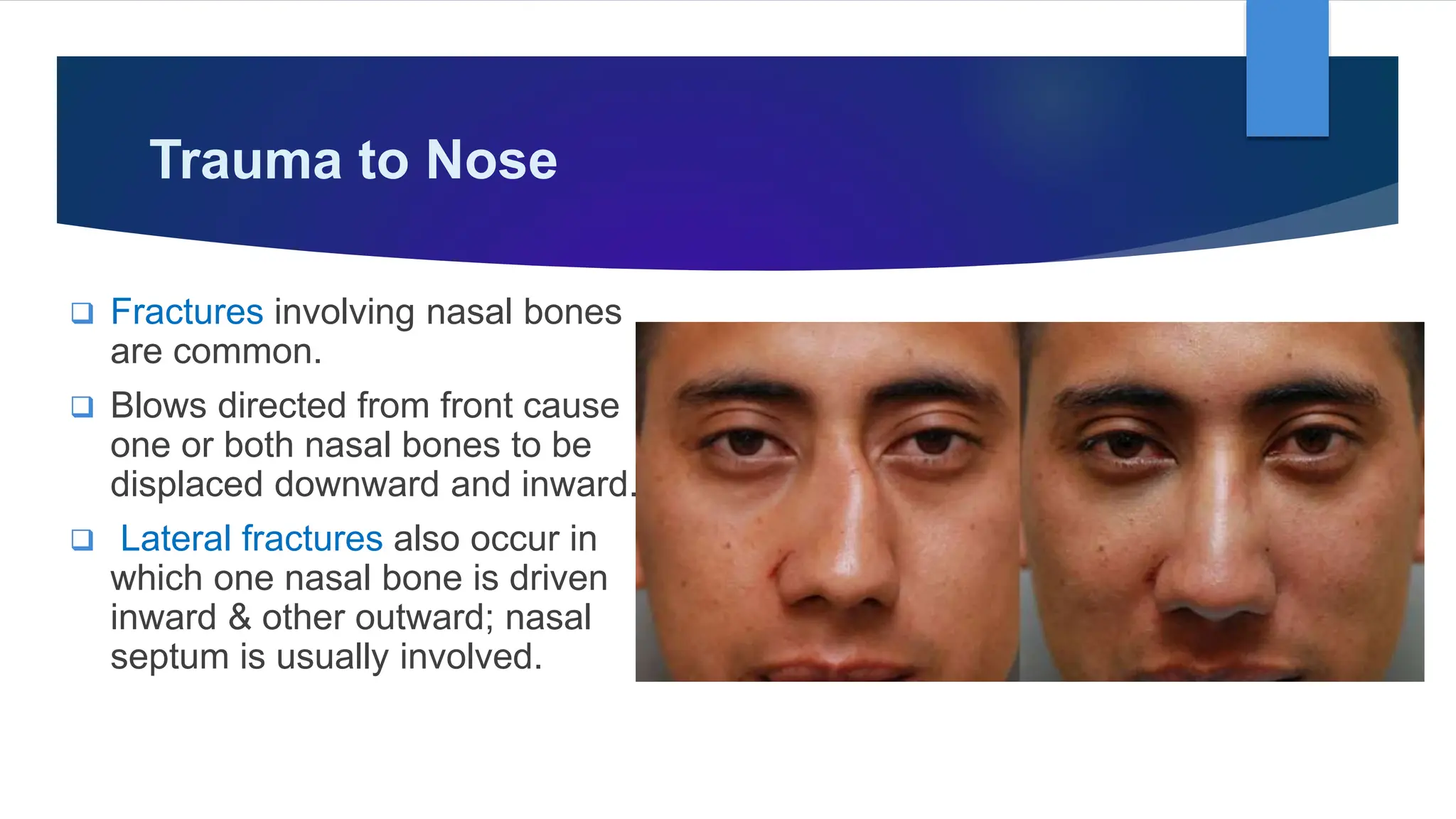 Nose-Nasal Cavity & Paranasal Sinuses BY Dr.Rabia Inam Gandapore.pptx