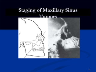nose and paranasal sinuses carcinoma presentation | PPT