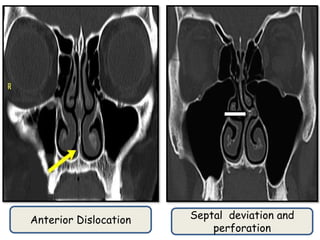 Nose anatomy and physiology | PPTX