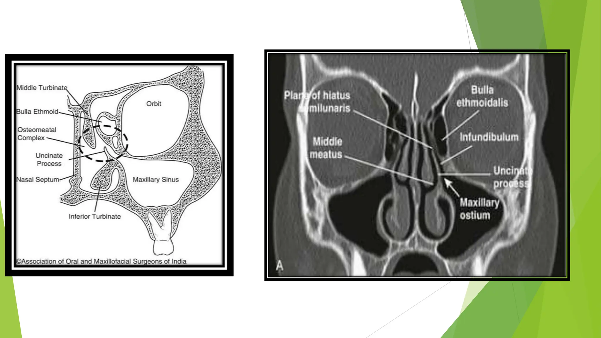 NOSE AND PARANASAL sinuses PPT & diagrams | PPT