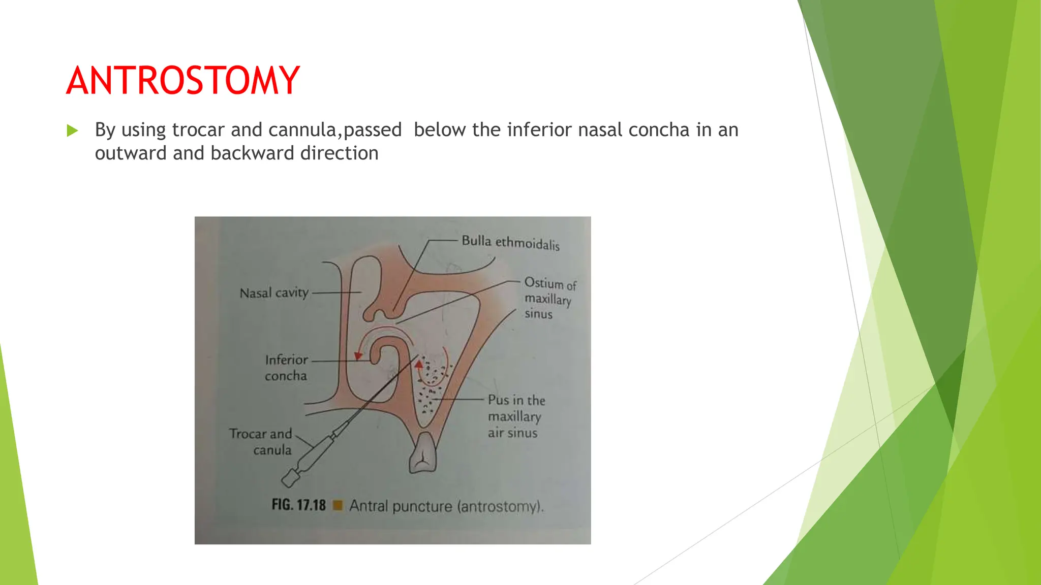 NOSE AND PARANASAL sinuses PPT & diagrams | PPTX