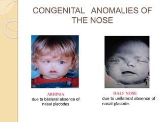 Nose and paranasal sinuses | PPTX