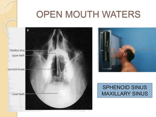 Nose and paranasal sinuses | PPTX