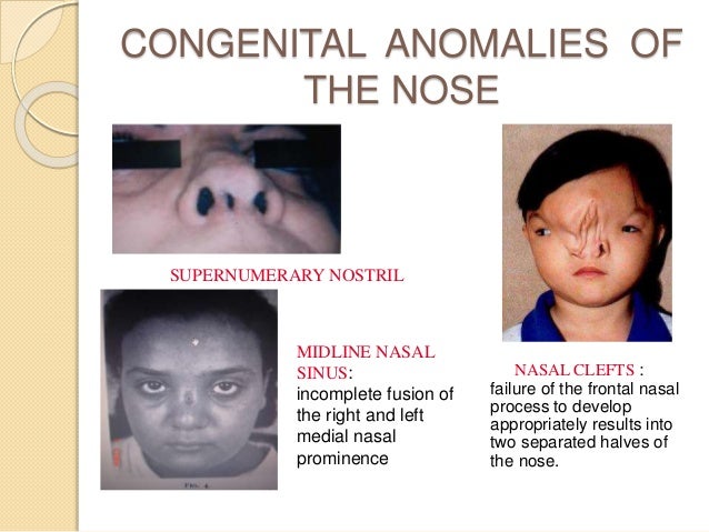 Nose and paranasal sinuses