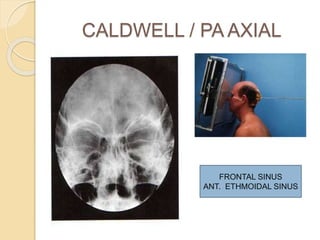 nose and paranasal sinuses EXCELLENT SLIDES TO CULL FROM NOSE SINUSES ...