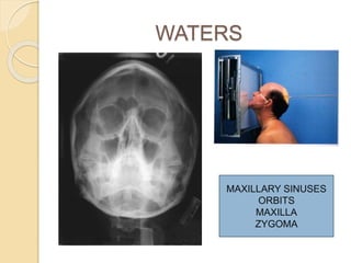 nose and paranasal sinuses EXCELLENT SLIDES TO CULL FROM NOSE SINUSES ...