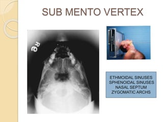 nose and paranasal sinuses EXCELLENT SLIDES TO CULL FROM NOSE SINUSES ...