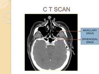 nose and paranasal sinuses EXCELLENT SLIDES TO CULL FROM NOSE SINUSES ...