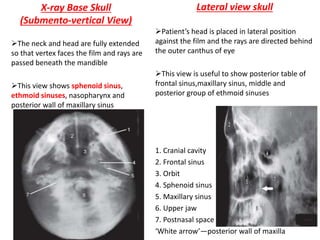 Anatomy of Nose and Paranasal Sinuses | PPTX