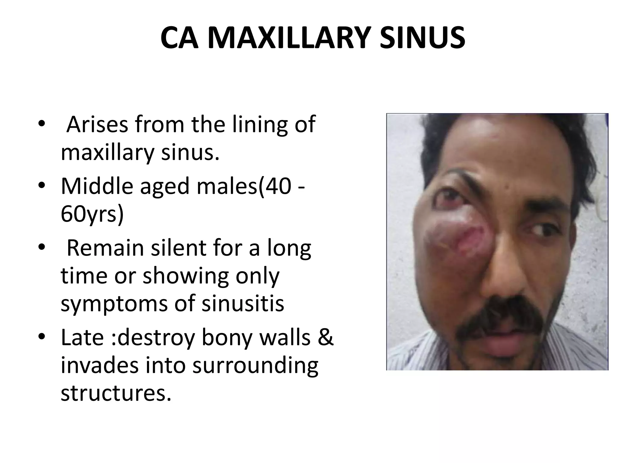 Nose and PNS Carcinoma (for UNDERGRADUATES) | PPTX