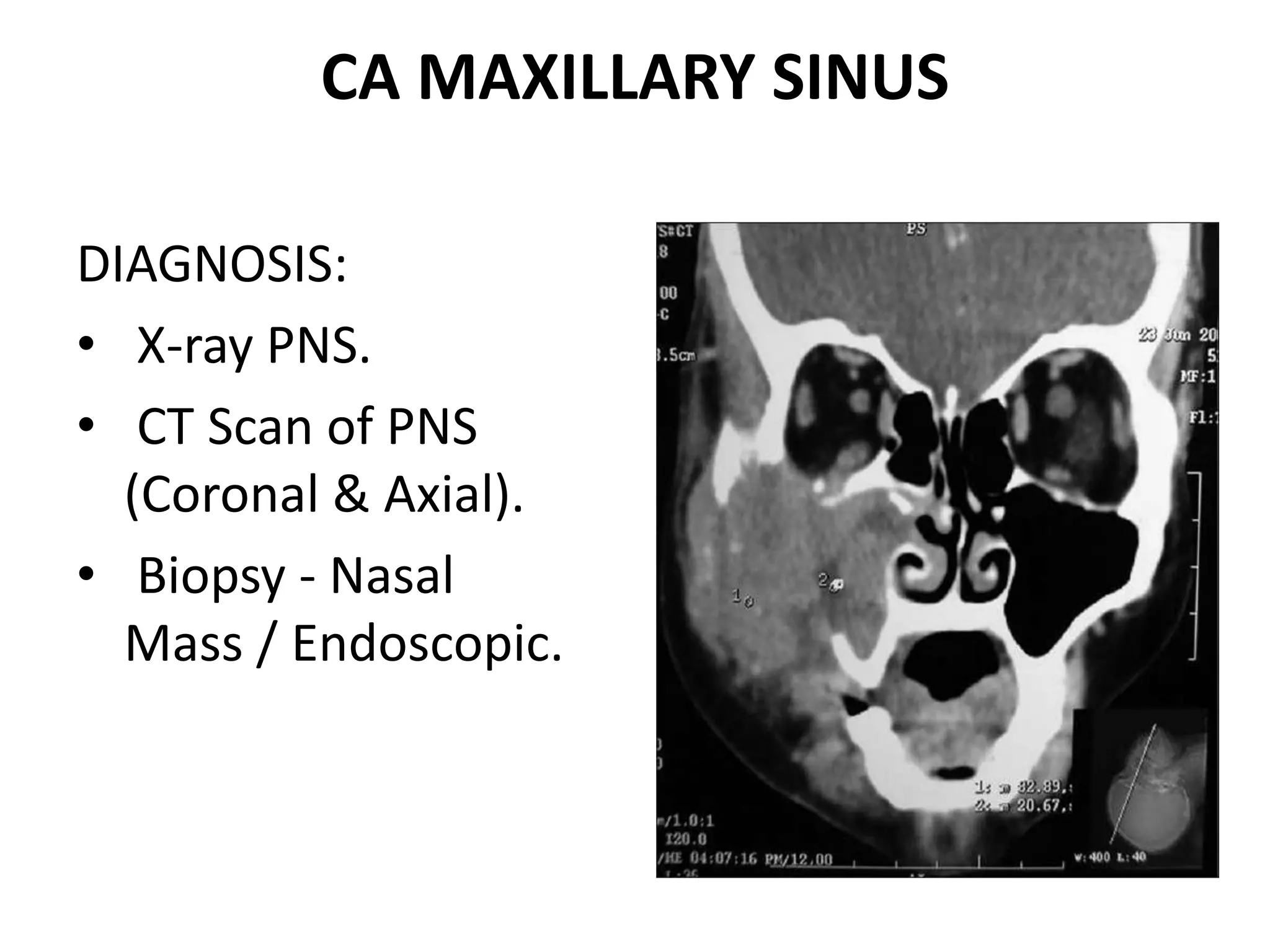 Nose and PNS Carcinoma (for UNDERGRADUATES) | PPTX