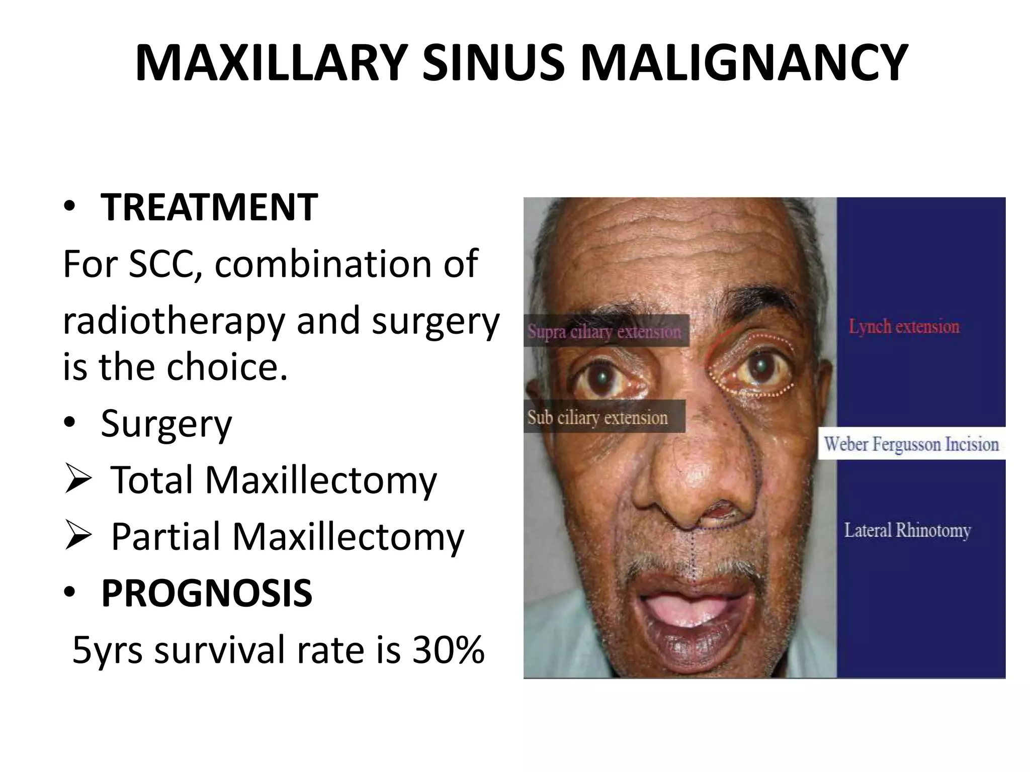 Nose and PNS Carcinoma (for UNDERGRADUATES) | PPTX