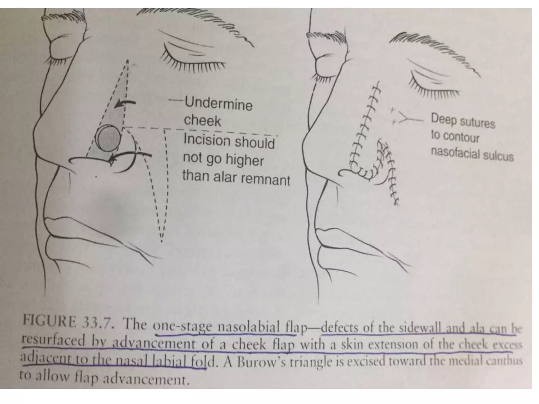 Nose reconstruction | PPTX