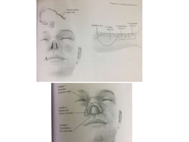 Nose reconstruction | PPTX