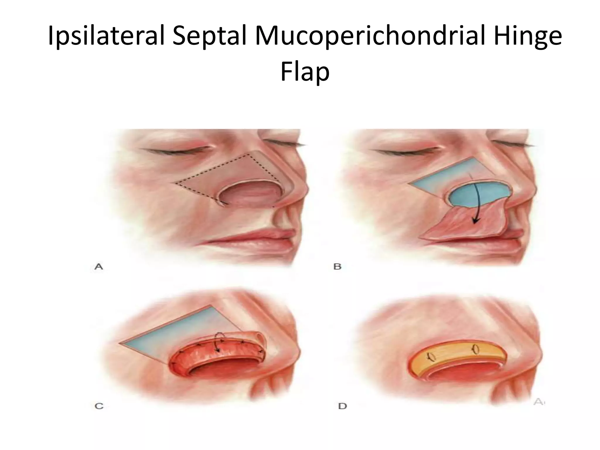 Nose reconstruction | PPTX