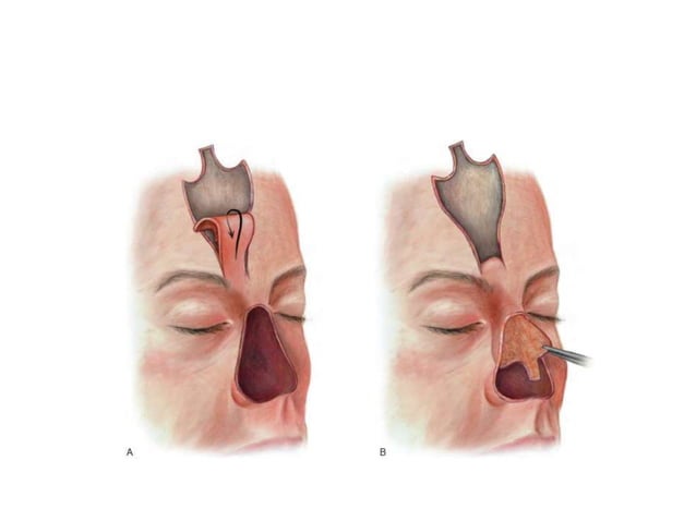 Nose reconstruction | PPTX