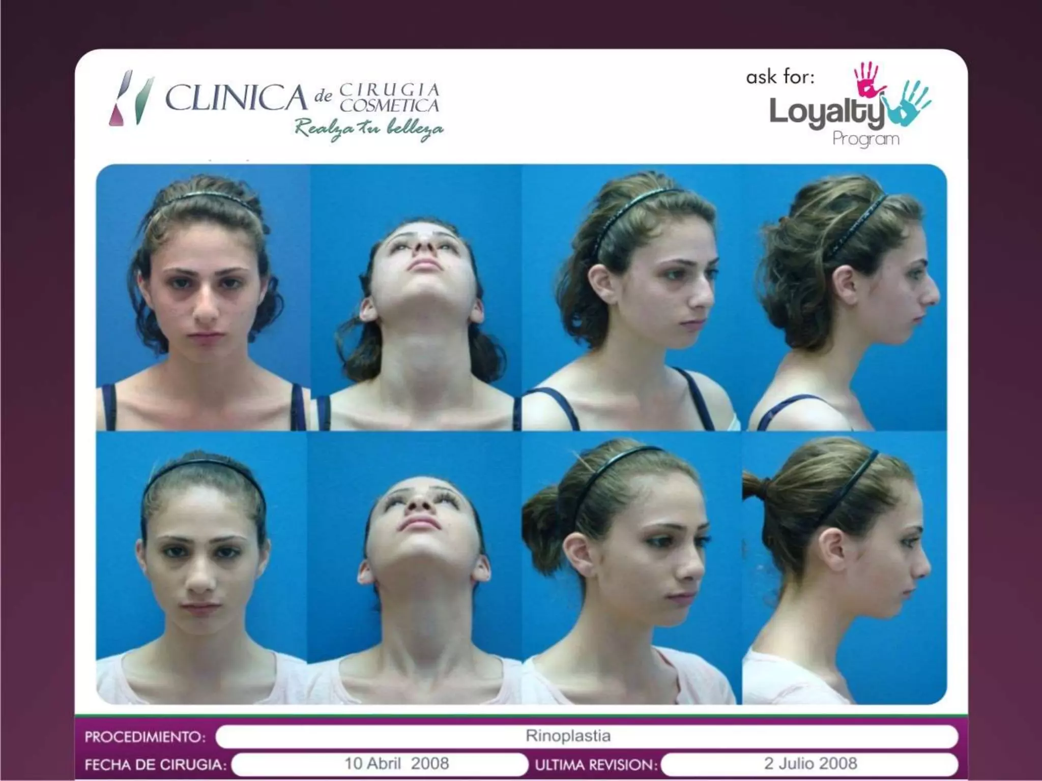 Nose surgery procedure rhinoplasty | PPSX