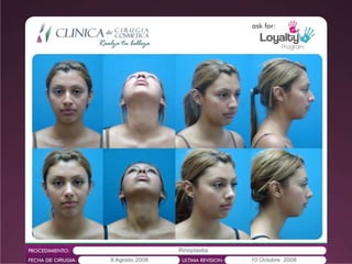 Nose surgery procedure rhinoplasty | PPSX