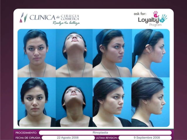 Nose surgery procedure rhinoplasty | PPSX