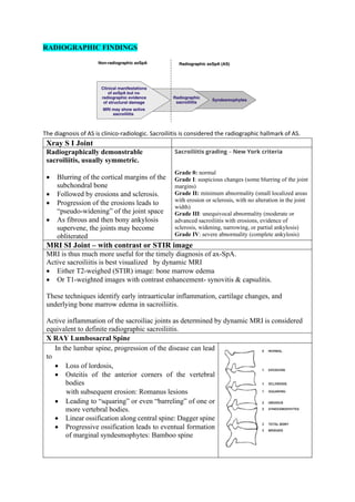 Ankylosing Spondylitis - Notes 2021 | PDF