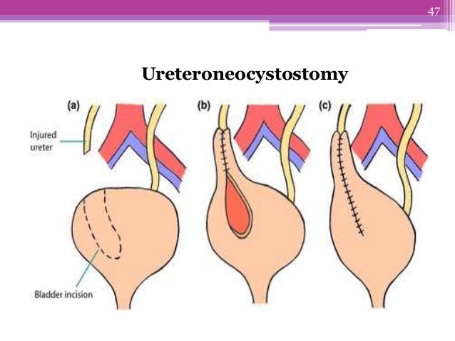 Notes on urinary disorders 2