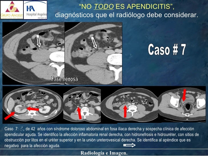 “No Todo Es Apendicitis”, DiagnóSticos Que El RadióLogo Debe Consider…
