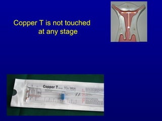 No touch loading technique | PPT | Birth Control | Reproductive Health