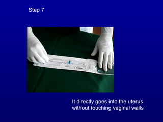 No touch loading technique | PPT | Birth Control | Reproductive Health