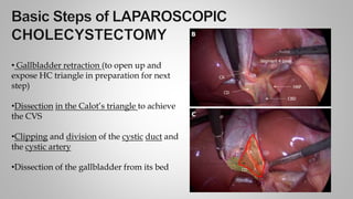 Laparoscpic Cholecystectomy by Dr.nowar | PPTX