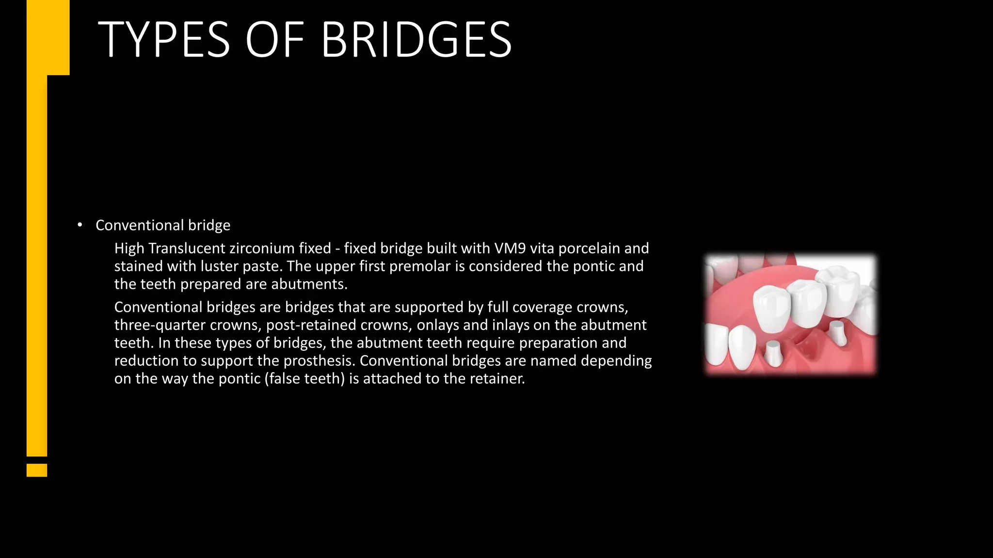 bridge and pontic design lecture | PDF | Dental Health | Diseases and ...