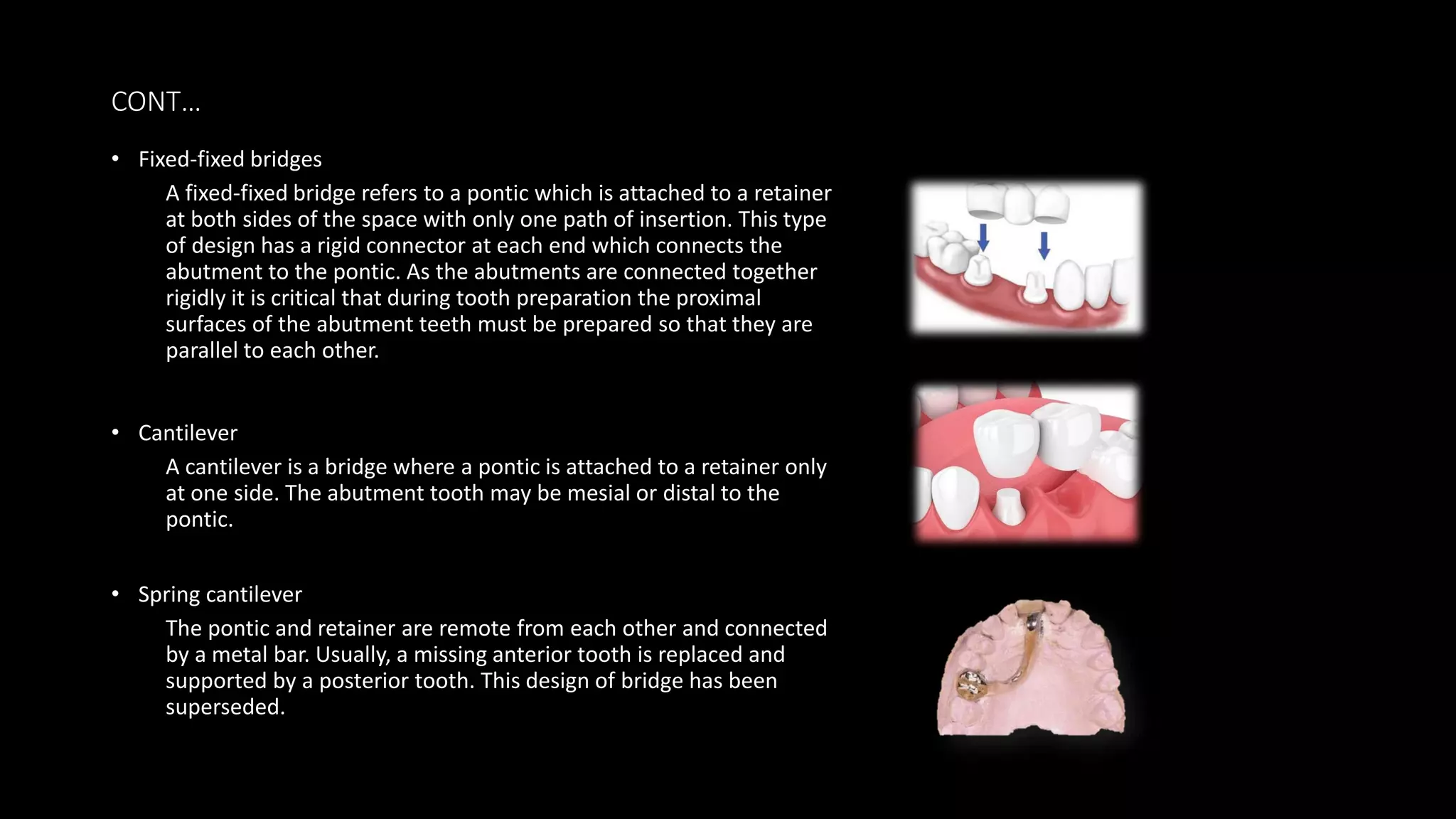 bridge and pontic design lecture | PDF