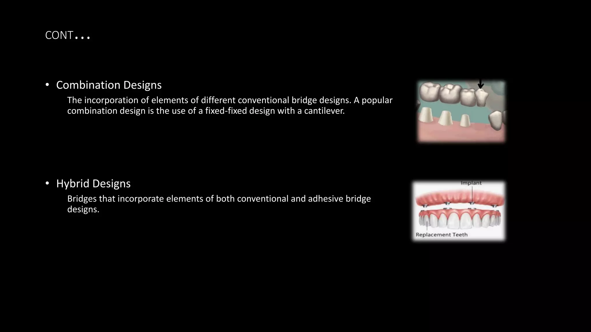 bridge and pontic design lecture | PDF