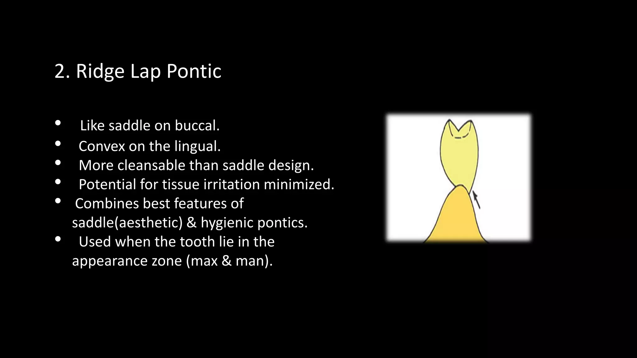 bridge and pontic design lecture | PDF