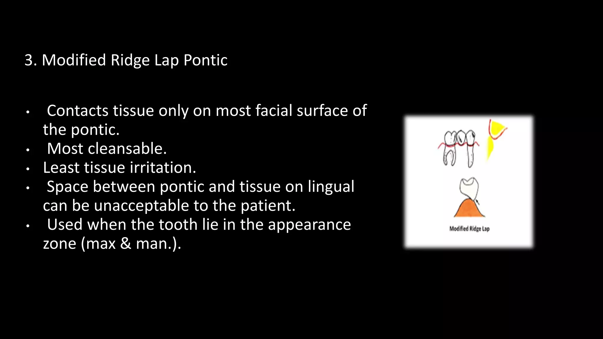 bridge and pontic design lecture | PDF