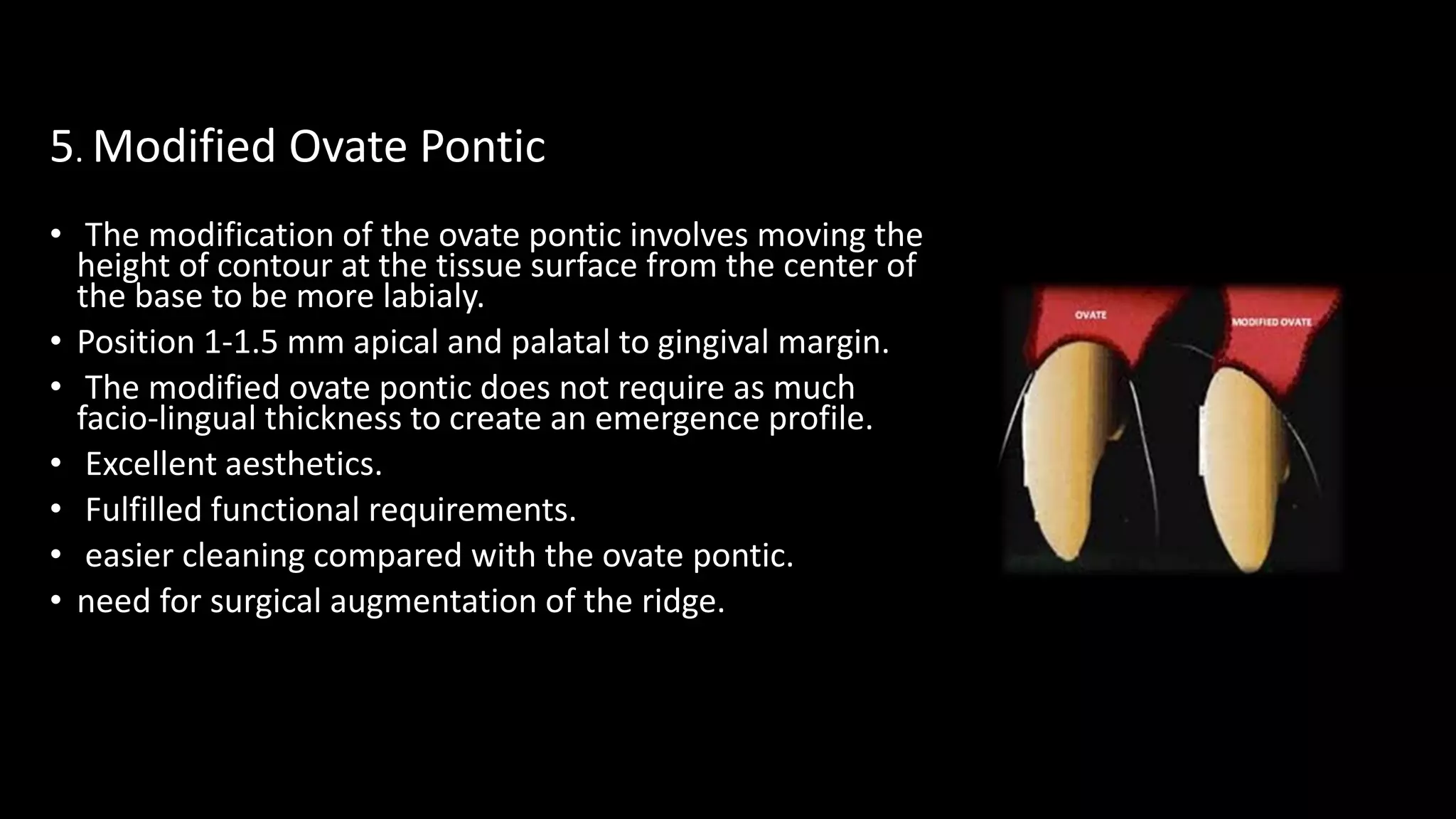 bridge and pontic design lecture | PDF
