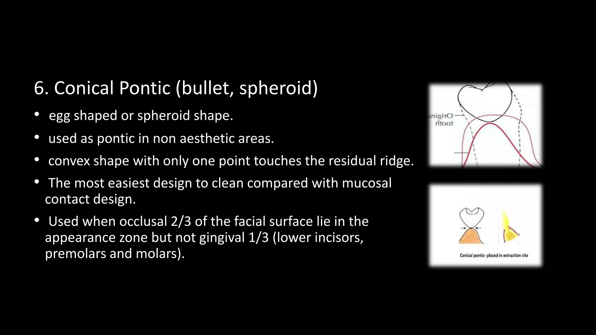 bridge and pontic design lecture | PDF