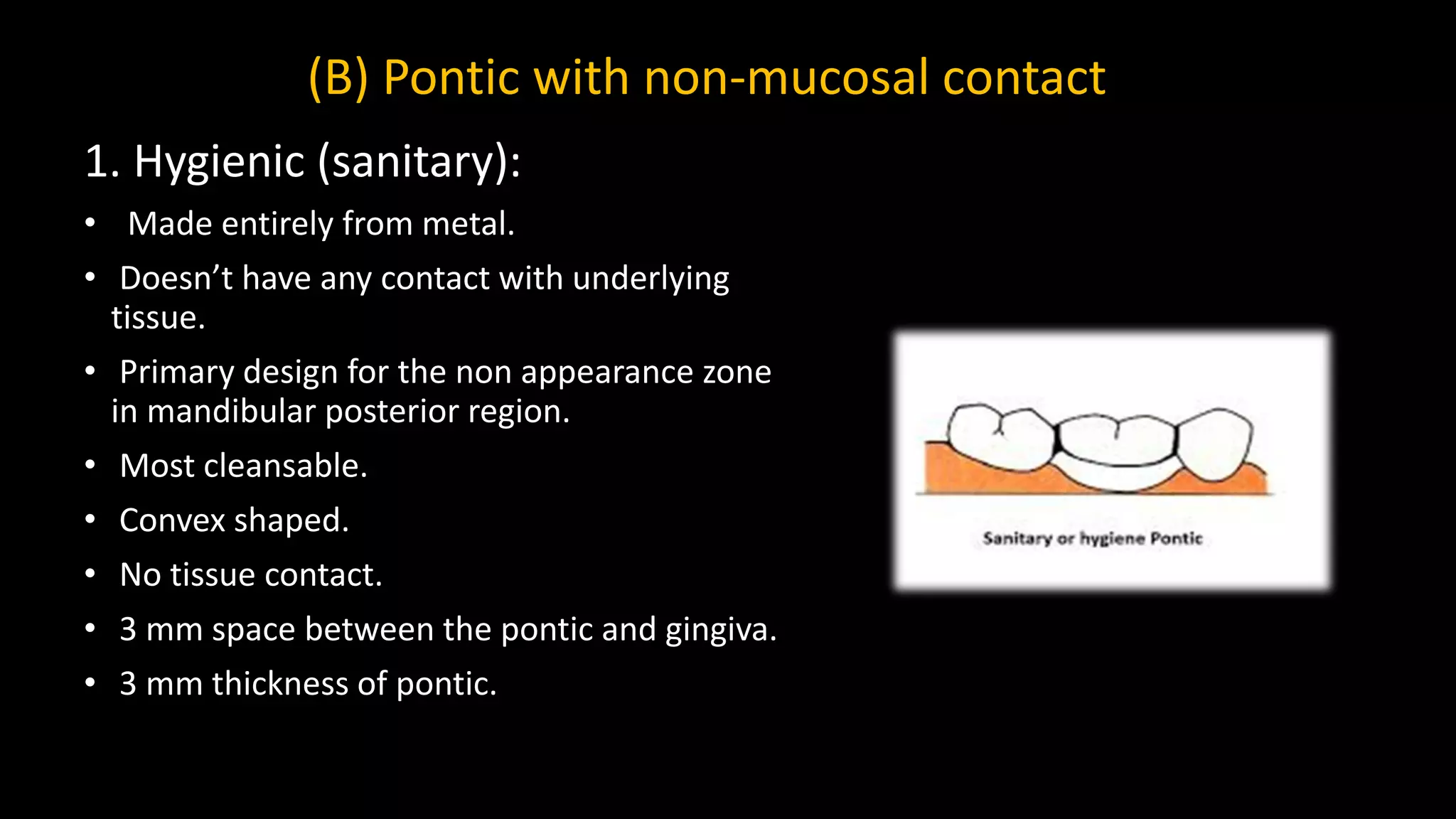 bridge and pontic design lecture | PDF