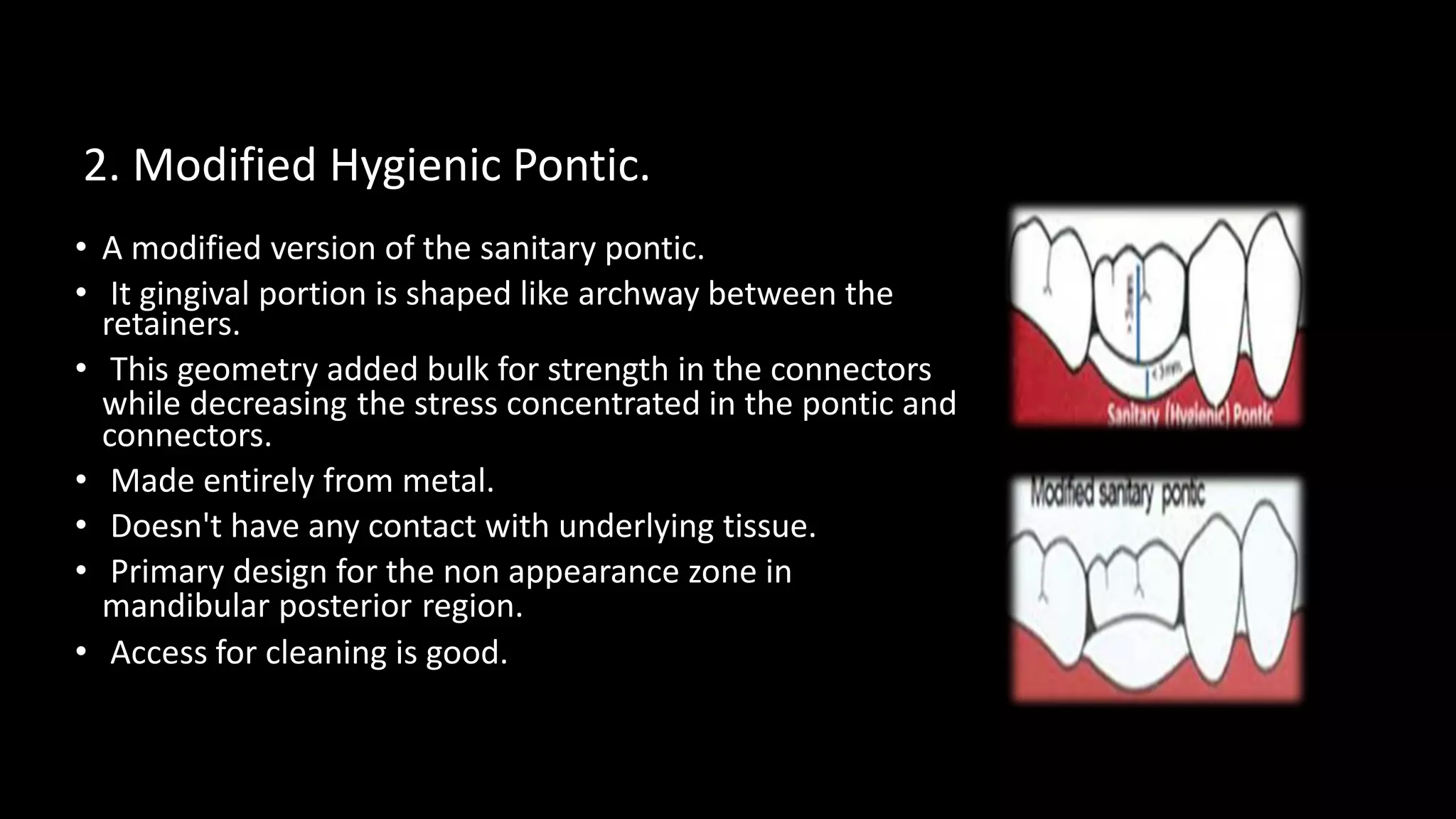 bridge and pontic design lecture | PDF