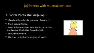 bridge and pontic design lecture | PDF