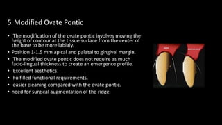 bridge and pontic design lecture | PDF