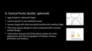 bridge and pontic design lecture | PDF